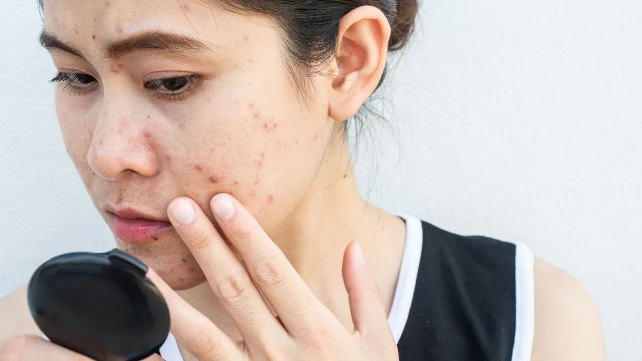 এইবাৰ বৃদ্ধি পাইছে ‘শ্লেপ্ড চিক’ ৰোগঃ কিয় হয় এই ৰোগ, চাওক সবিশেষ ...